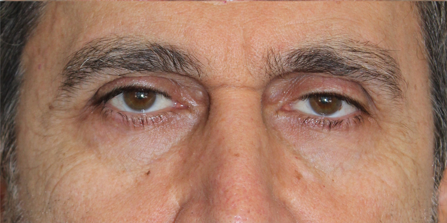 Blepharoplasty (Lower Eyelid) 18 - Dr. David Isaacs
