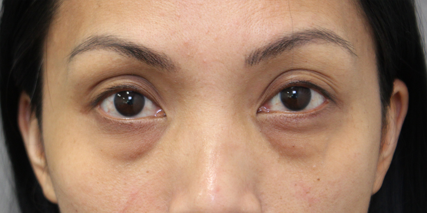 Blepharoplasty (Lower Eyelid) 5 - Dr. David Isaacs