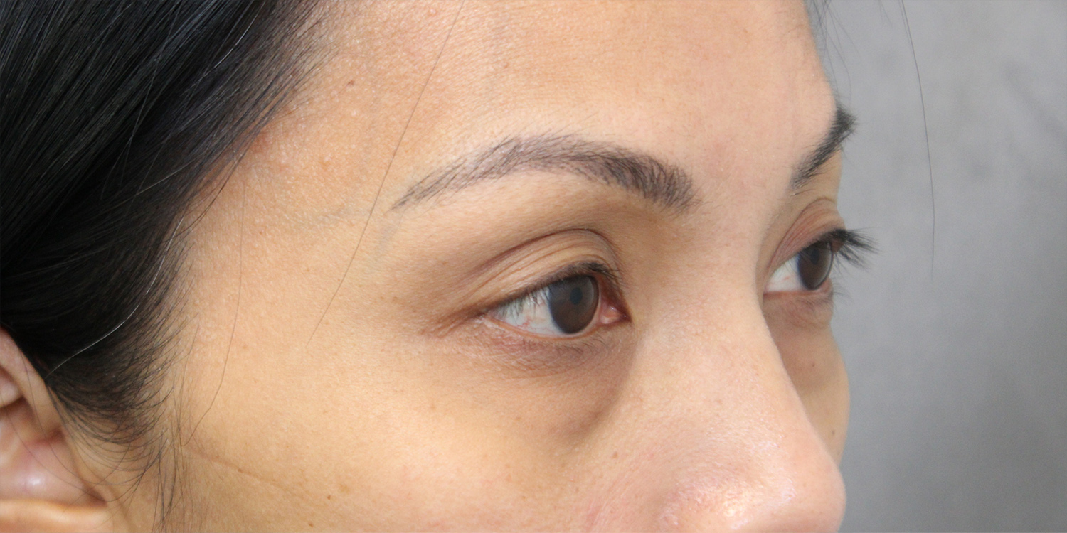 Blepharoplasty (Lower Eyelid) 5 - Dr. David Isaacs