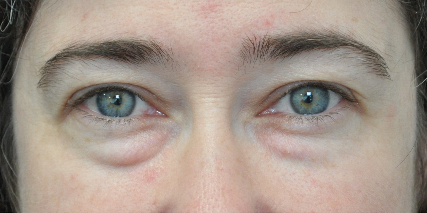 Blepharoplasty (Upper Eyelid) 3 - Dr. David Isaacs