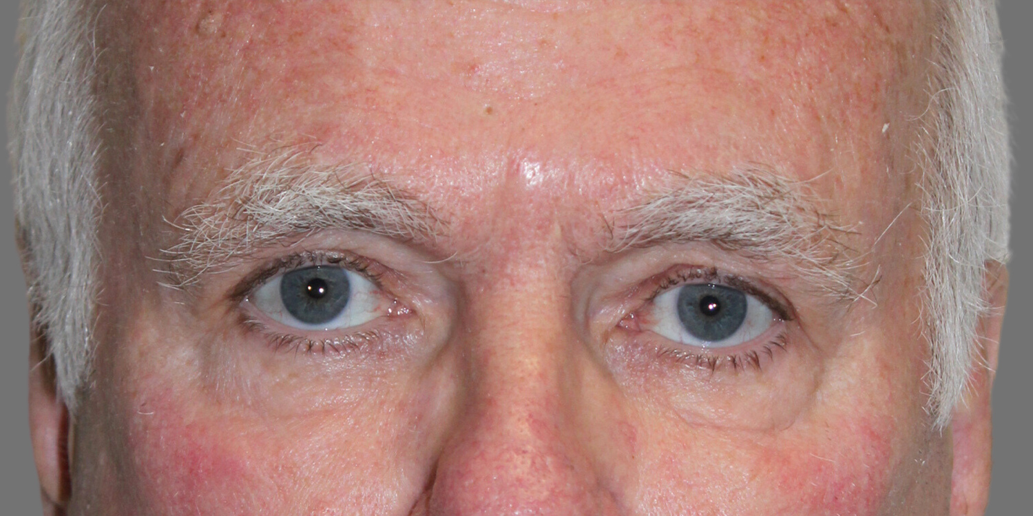 Blepharoplasty (Upper Eyelid) 4 - Dr. David Isaacs